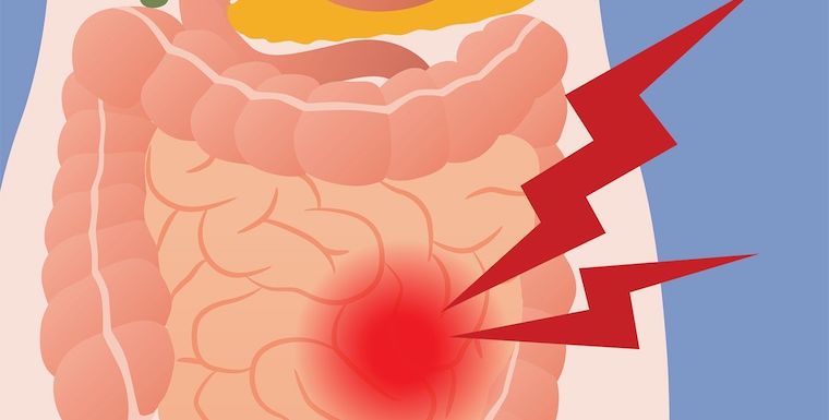 Causas de inflamación en el intestino que debes saber